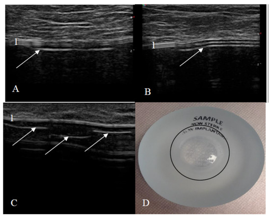 The Value of Ultrasound in the Evaluation of the Integrity of Silicone ...
