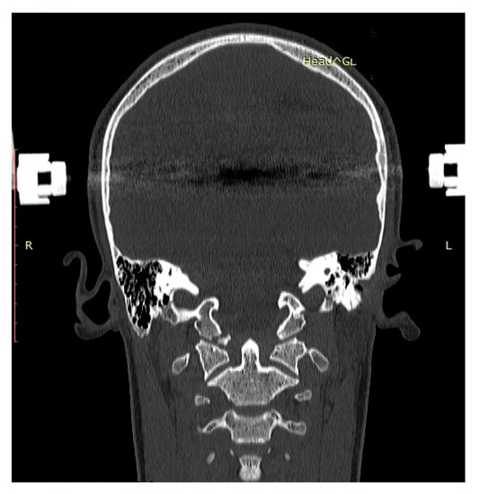 Treatment of Unstable Occipital Condylar Fractures in Children—A STROBE ...