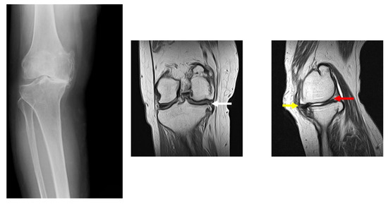 A Simulation Case Study of Knee Joint Compressive Stress during the ...