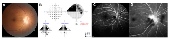 Altitudinal Visual Field Defects Following Diagnostic Transfemoral ...
