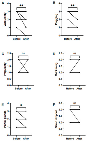 Meibomian Gland Dysfunction: Intense Pulsed Light Therapy in ...