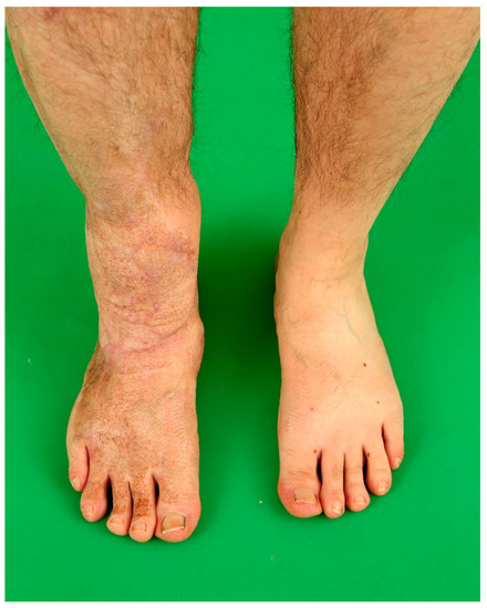 Implementation and Validation of Free Flaps in Acute and Reconstructive ...