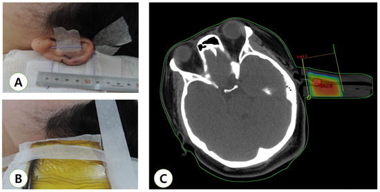Adjuvant Radiotherapy after Surgical Excision in Keloids