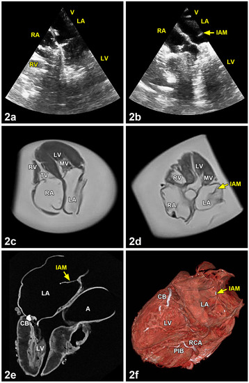 Cor Triatriatum Sinistrum Combined with Changes in Atrial Septum and ...