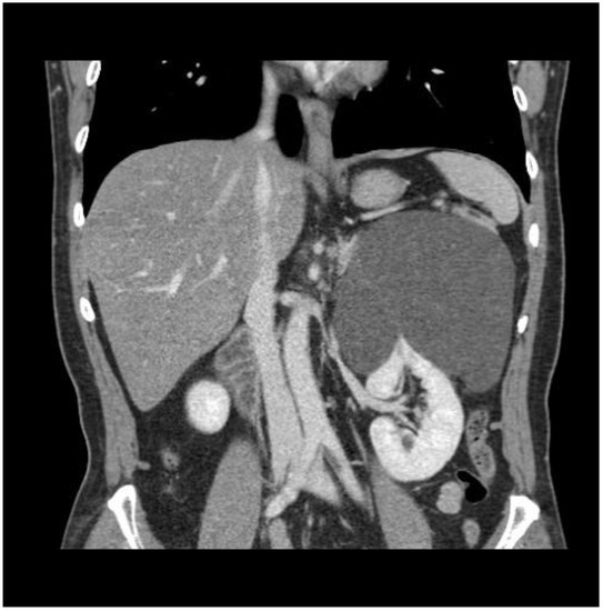 Medicina | Free Full-Text | Tubulocystic Renal Cell Carcinoma Is Not an ...