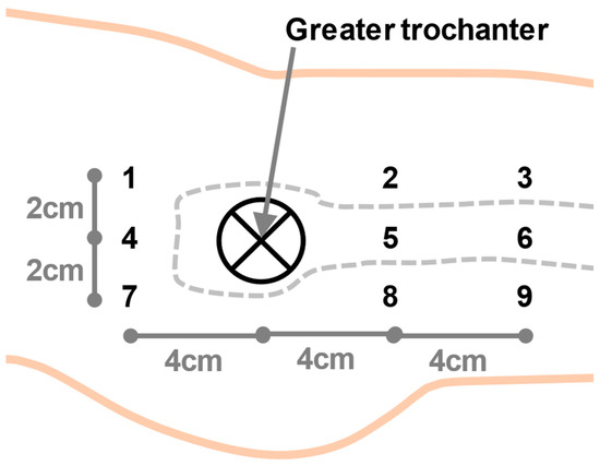 Trochanteric Femur Fractures: Application of Skeletal Traction during ...