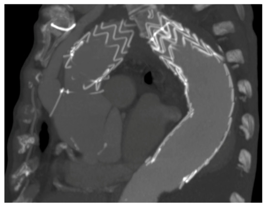 Hybrid Surgery to Manage Aortic Arch Pathology