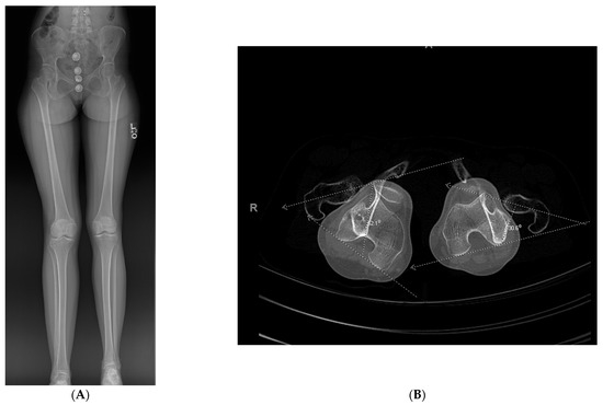 The Clamshell Osteotomy for Diaphyseal Malunion in Deformity Correction ...