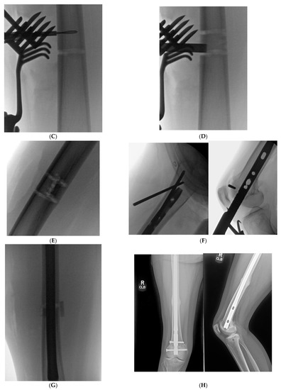 The Clamshell Osteotomy for Diaphyseal Malunion in Deformity Correction ...