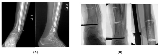 The Clamshell Osteotomy for Diaphyseal Malunion in Deformity Correction ...