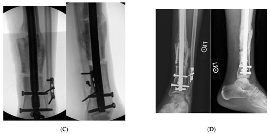 The Clamshell Osteotomy for Diaphyseal Malunion in Deformity Correction ...