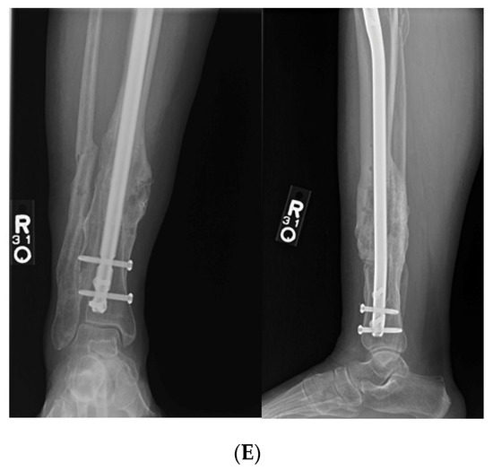 The Clamshell Osteotomy for Diaphyseal Malunion in Deformity Correction ...