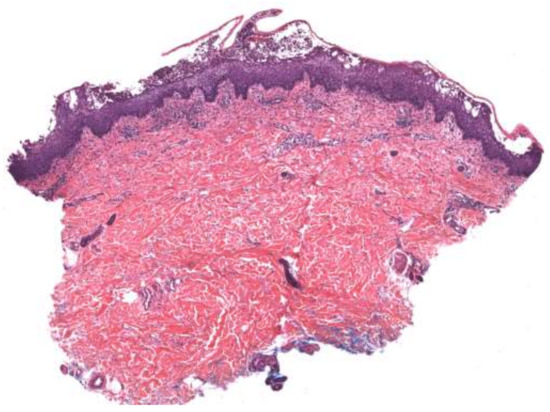 Pustular Psoriasis and Acute Generalized Exanthematous Pustulosis