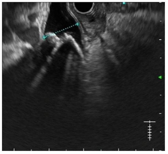 EUS and ERCP in the Same Session for Biliary Stones: From Risk ...