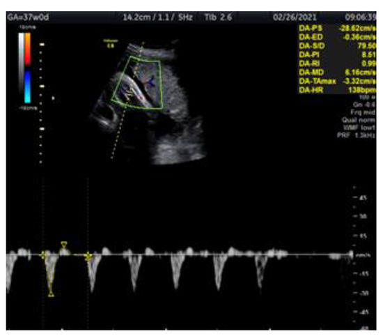 Medicina | Free Full-Text | Doppler Ultrasonography of the Fetal Tibial ... Medicina | Free Full-Text | Doppler Ultrasonography of the Fetal Tibial ...