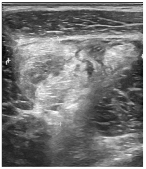 Ultrasound Imaging in Sport-Related Muscle Injuries: Pitfalls and ...