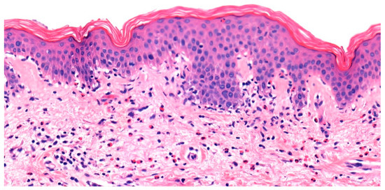 Cicatricial Pemphigoid Histology