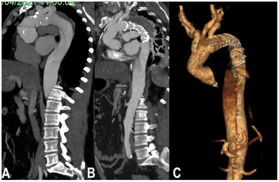 Frozen Elephant Trunk in Aortic Arch Disease: Different Devices for ...