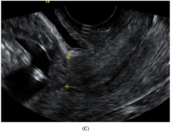 Transvaginal Sonographic Evaluation of Cesarean Section Scar Niche in ...