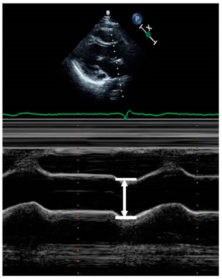 Prediction of Judkins Left Catheter Size during Left Transradial ...