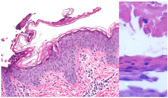Staphylococcal Scalded Skin Syndrome and Bullous Impetigo