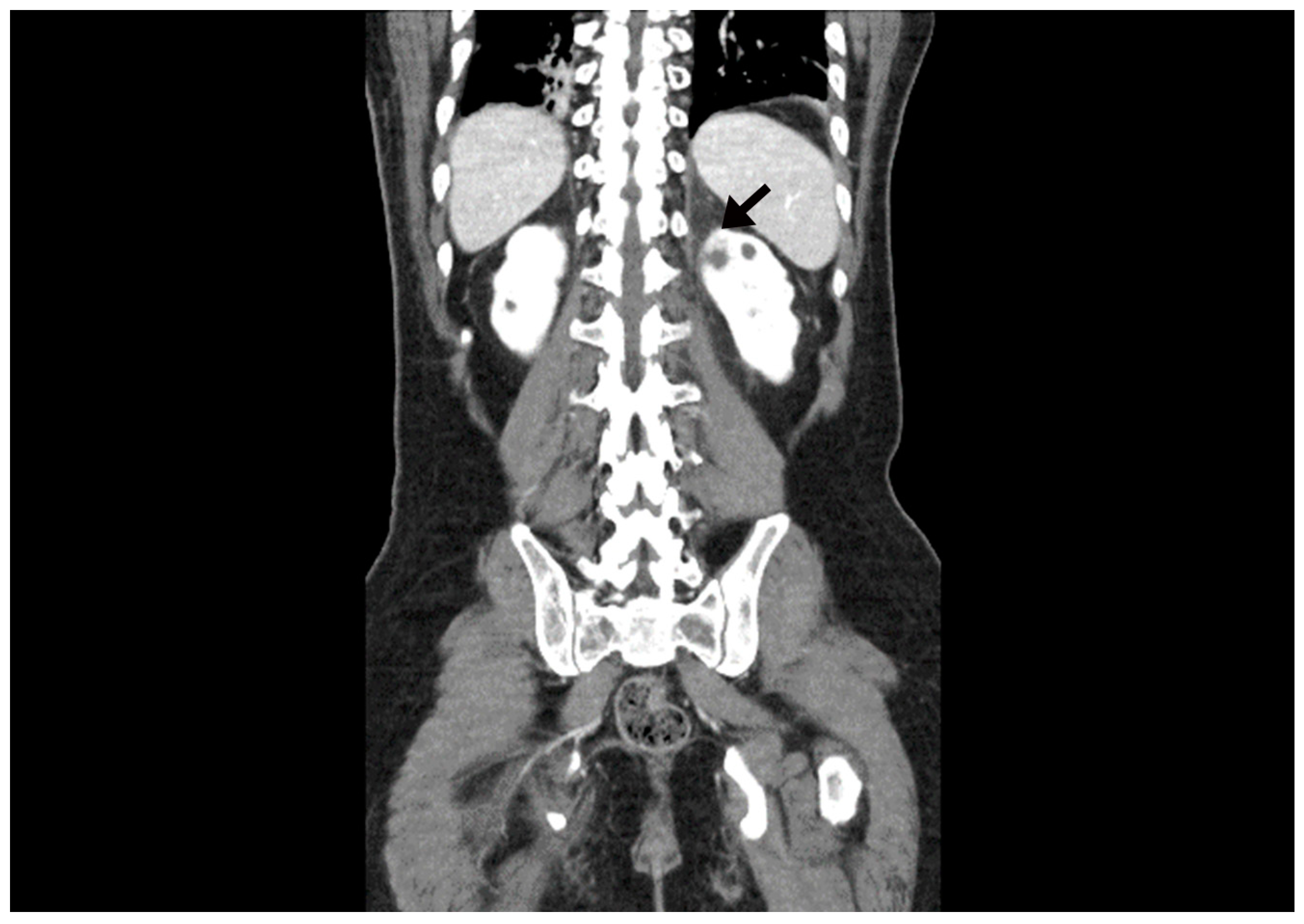 Urothelial Cell Carcinoma of the Renal Pelvis Misdiagnosed as ...