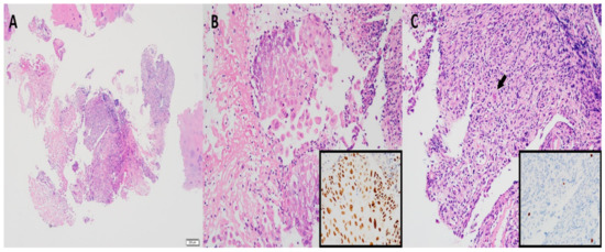 Tracheitis Caused by Coinfection with Cytomegalovirus and Herpes ...