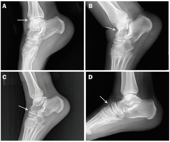 Accessory Ossicles in the Region of the Foot and Ankle: An ...
