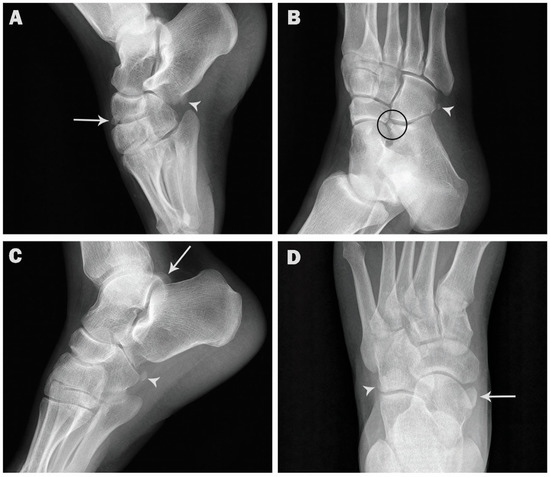 Accessory Ossicles in the Region of the Foot and Ankle: An ...