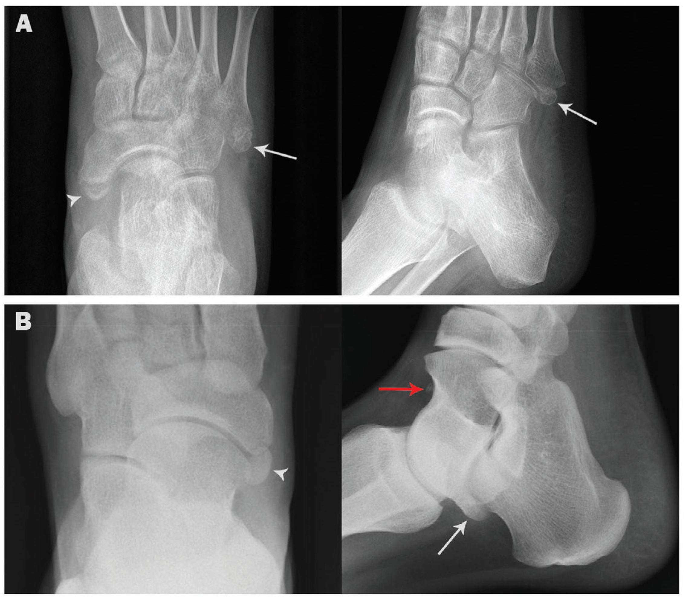 Accessory Ossicles In The Region Of The Foot And Ankle An Epidemiologic Survey In A Jordanian
