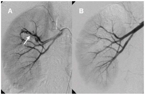 Congenital Renal Arteriovenous Malformation: Diagnostic Clues and Methods