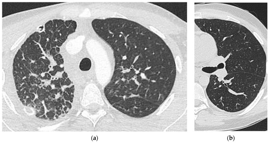 Effective Initial Treatment of Diffuse Pulmonary Lymphangiomatosis with ...