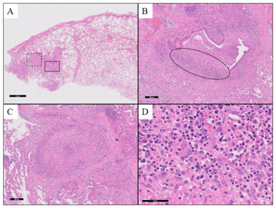 Determining Response to Treatment for Drug-Induced Bronchocentric ...