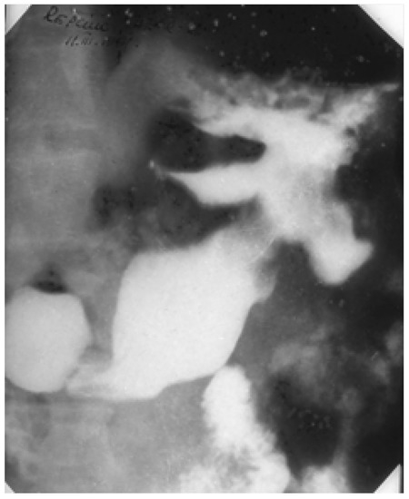 Unusual Complicated Gastric Ulcers