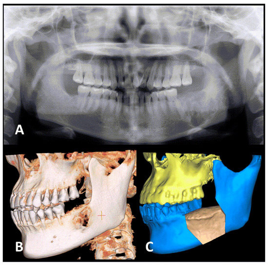 Use of the Cover-Lifting Technique in Mandibular Cemento-Ossifying ...