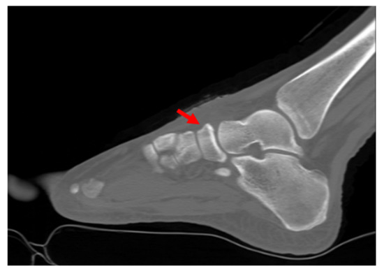Treatment of Navicular Stress Fracture Accompanied by Os ...