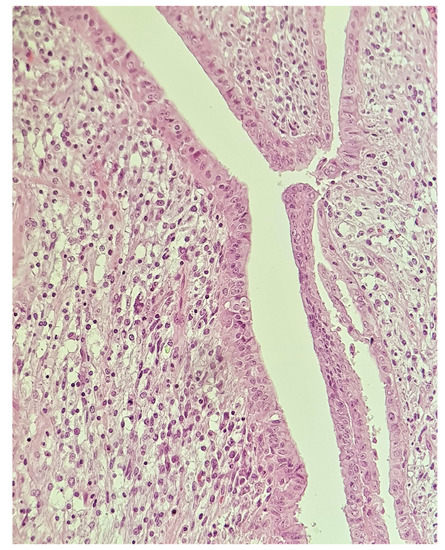 Malignant Phyllodes Tumor of the Breast and Pregnancy: A Rare Case ...
