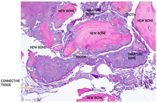 Autologous Tooth Dentin Graft: A Retrospective Study in Humans