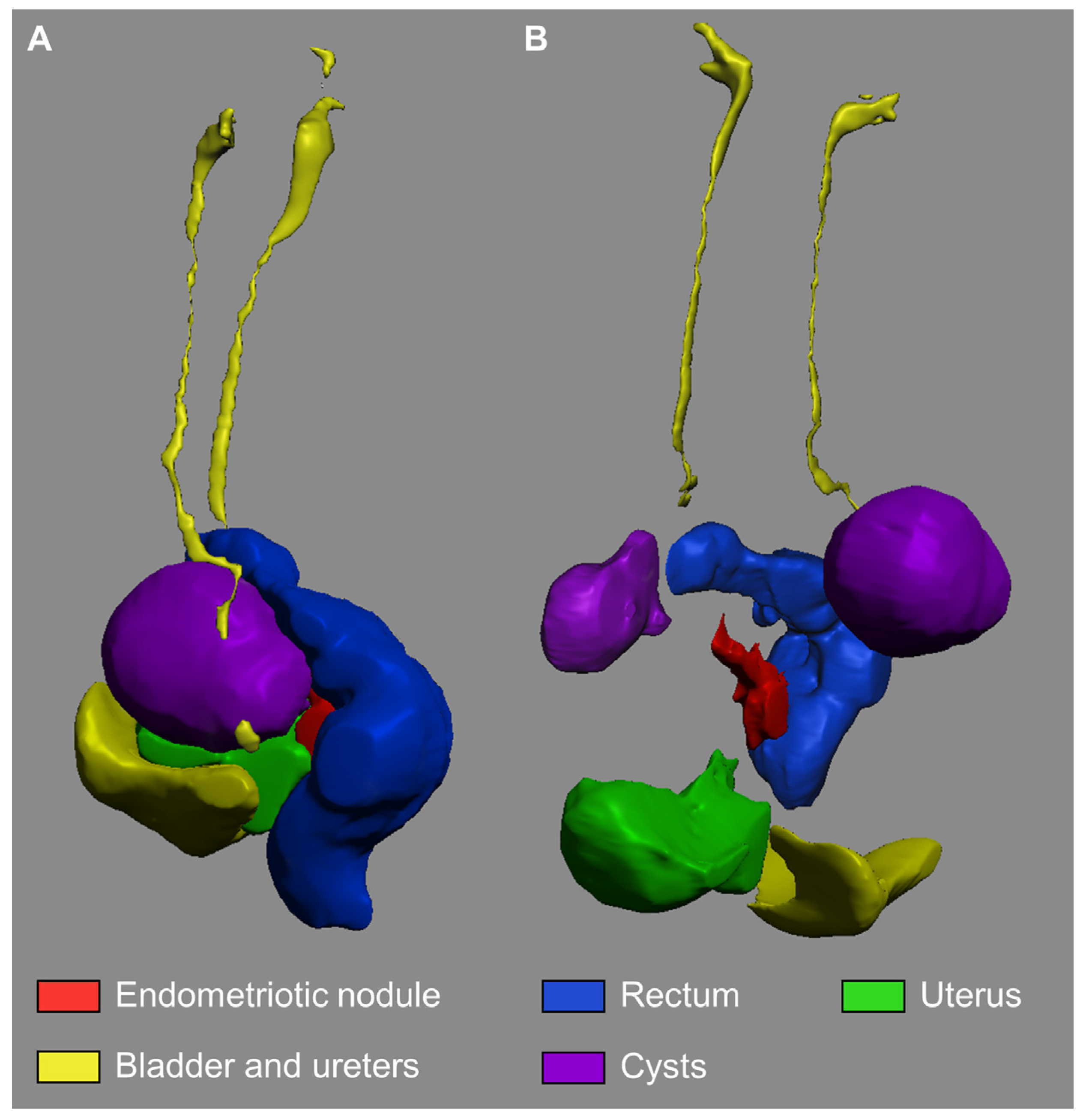 3D Patient-Specific Virtual Models for Presurgical Planning in Patients ...