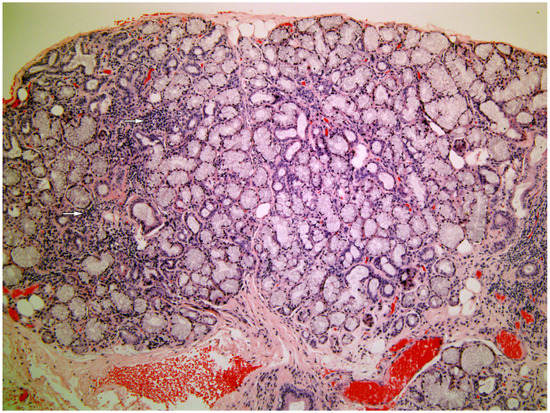 Acinar Atrophy, Fibrosis and Fatty Changes Are Significantly More ...