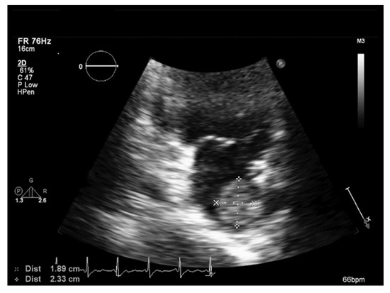 Left Atrial Fibroelastoma as a Cause of Stroke: A Case Report