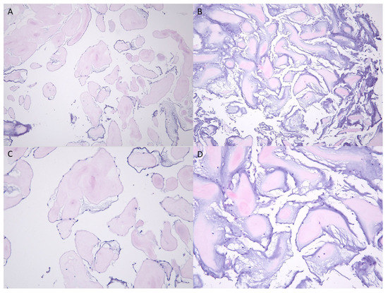 Left Atrial Fibroelastoma as a Cause of Stroke: A Case Report
