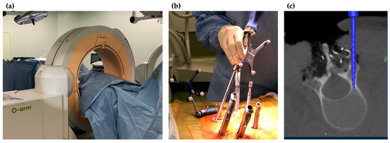 Computed Tomography-Based Navigation System in Current Spine Surgery: A ...