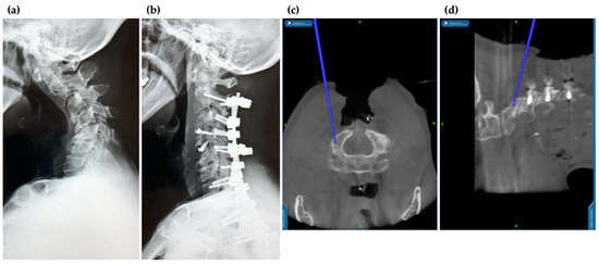 Computed Tomography-Based Navigation System in Current Spine Surgery: A ...