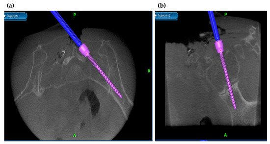 Computed Tomography-Based Navigation System in Current Spine Surgery: A ...