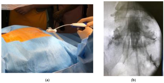 Efficacy of Minimally Invasive Trans-Sacral Canal Plasty between ...