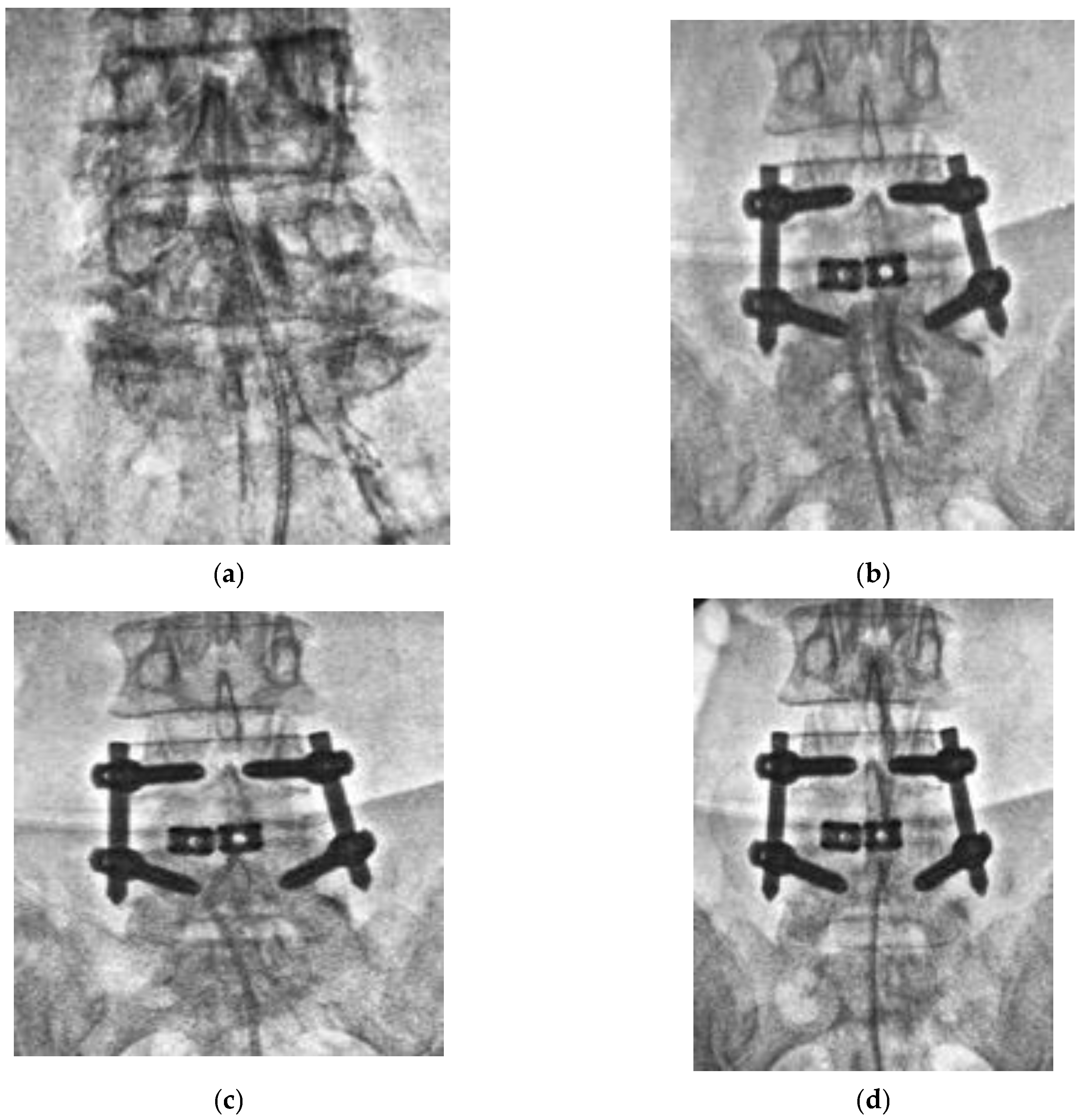 Efficacy of Minimally Invasive Trans-Sacral Canal Plasty between ...