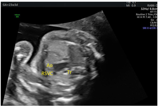 The Additional Role of the 3-Vessels and Trachea View in Screening for ...