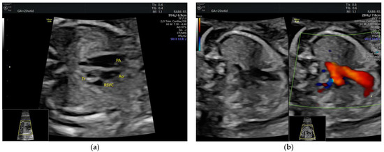 The Additional Role of the 3-Vessels and Trachea View in Screening for ...