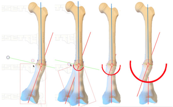 Medicina | Special Issue : Malunion of Fractures of the Lower Extremity